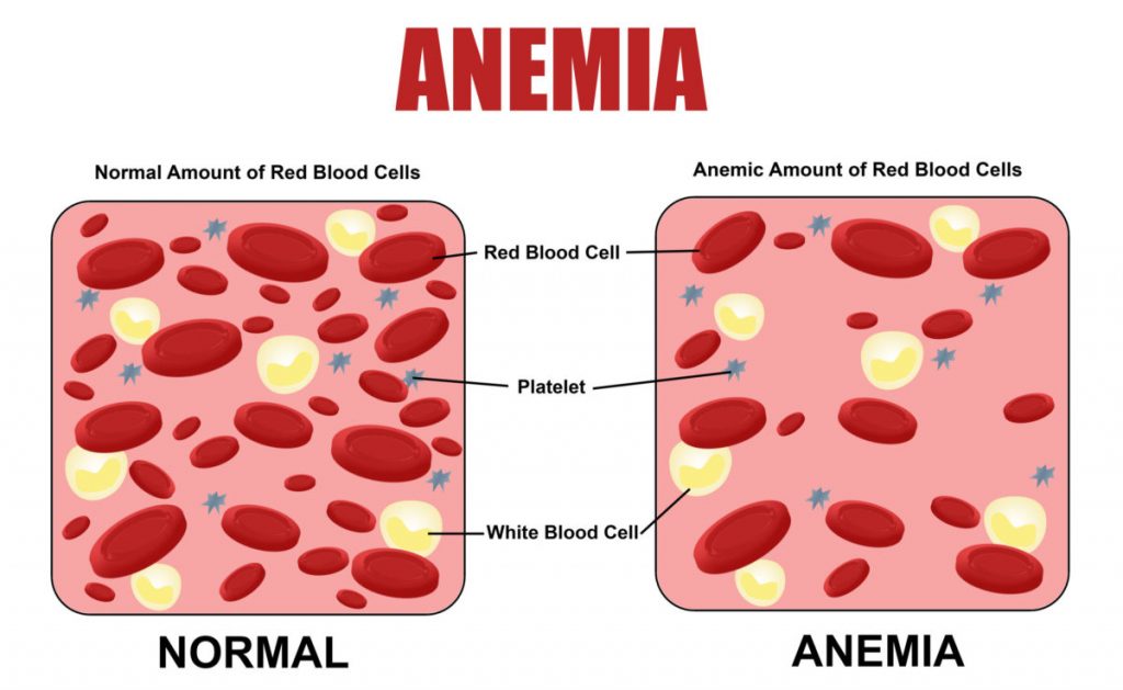 Apa Itu Anemia (Kurang Darah) – Puskesmas Kaligondang