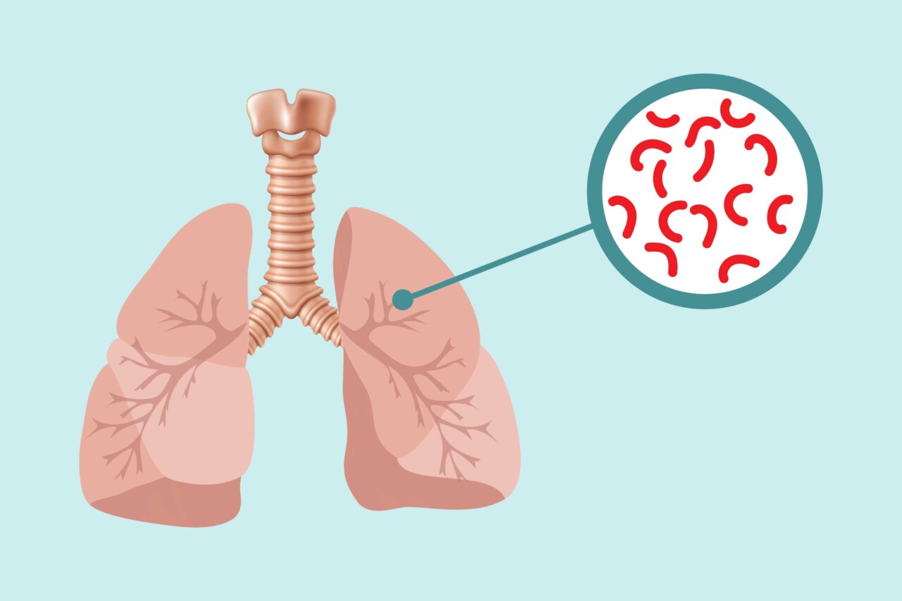 TBC (Tuberkulosis) – Puskesmas Kaligondang
